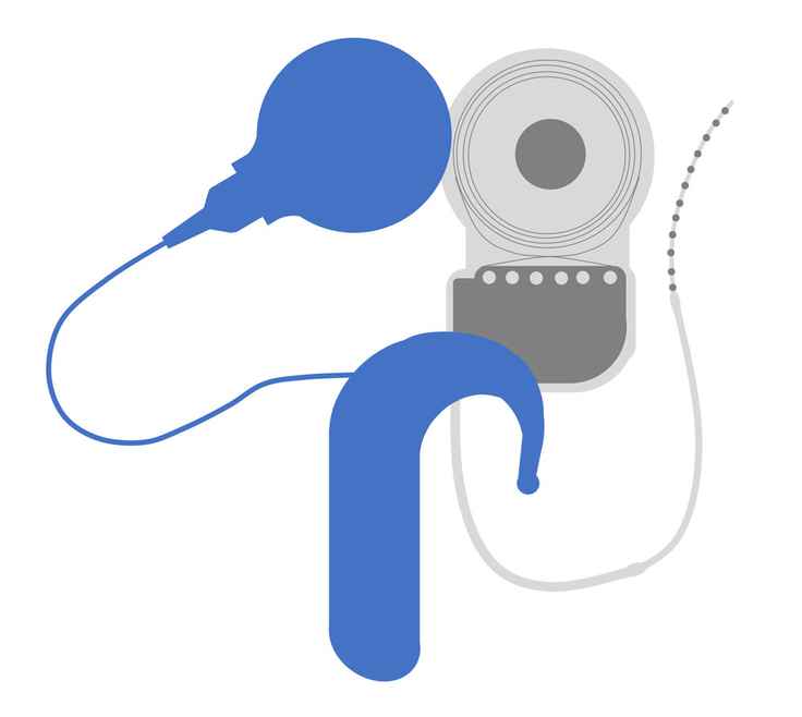 The Cochlear-Implant Side Effect You Should Know About