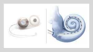 Advanced Bionics Cochlear Implant System