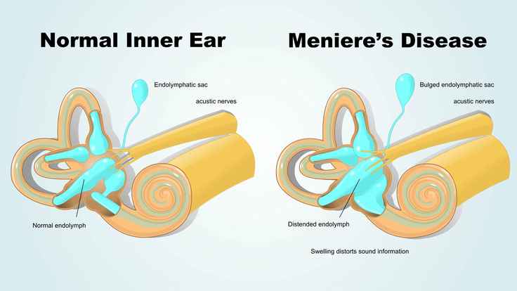 Meniere’s Disease: Symptoms, Diagnosis, and Treatment