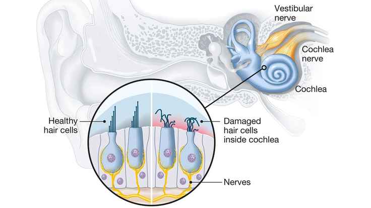 Inflammatory Arthritis, Autoimmune Disease, and Hearing Loss