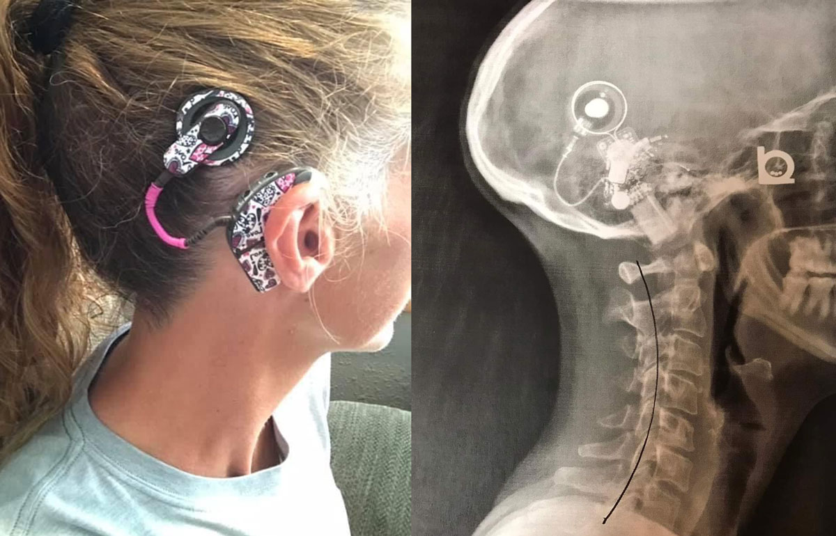 Cochlear Implant Surgery Scar