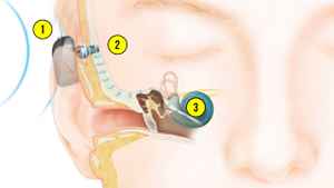 Cochlear Baha® 6 Max Bone Anchored Hearing Aids | Reviews and Prices