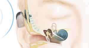 Bone-Anchored Hearing Aids: How They Work and What They Cost