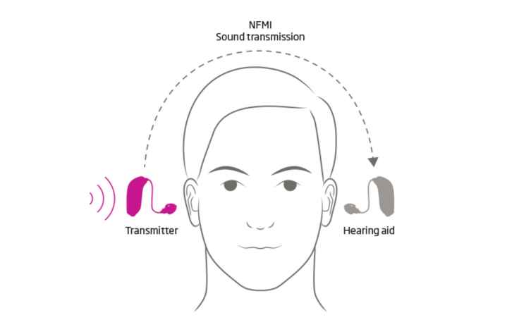 What are CROS and BiCROS Hearing Aids and Who Needs Them?