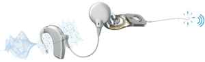 Advanced Bionics Cochlear Implant System