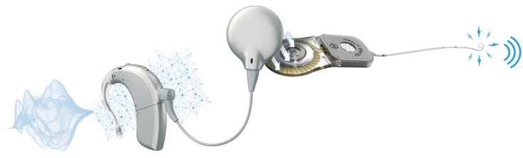 Advanced Bionics Cochlear Implant System