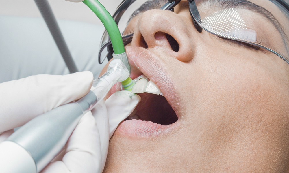 Professional rotary polishing – using the prophylaxis instruments from ...