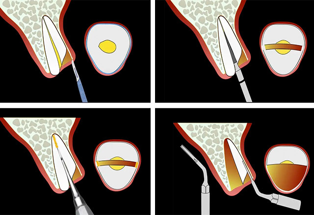 Atraumatic Tooth Extraction: Clinical Perspectives from Prof. José ...