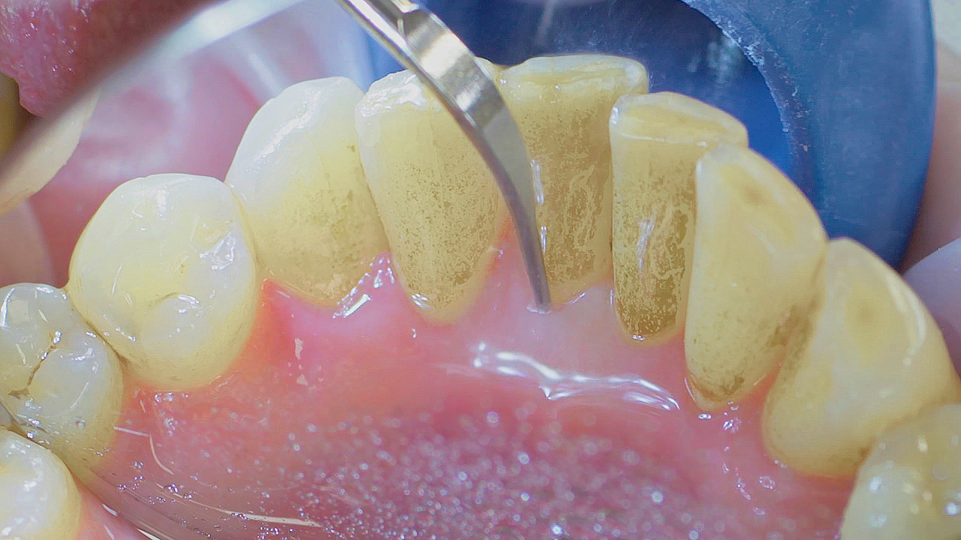 Implants should only be inserted when periodontal conditions are stable ...