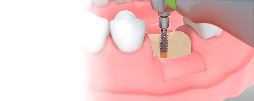 Implantmed Plus & Classic | W&H