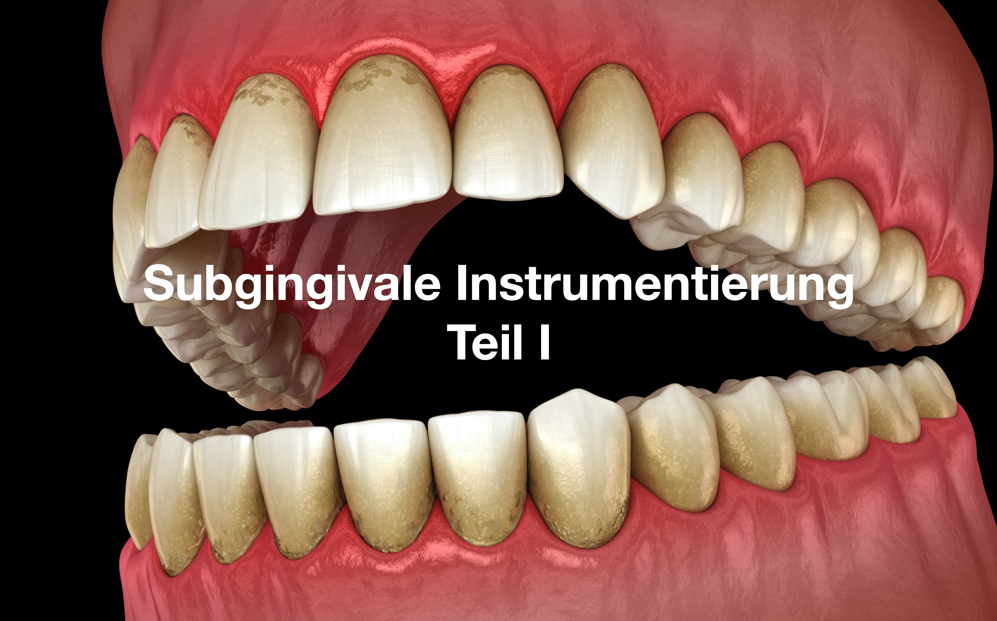Subgingival instrumentation – Part I | Wehadent Iberica