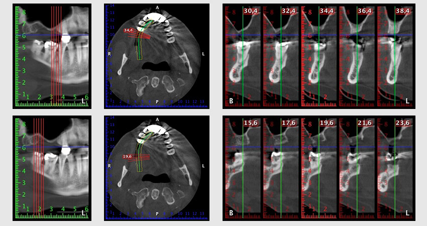 Implant therapy with the Implantmed surgical unit from W&H | W&H