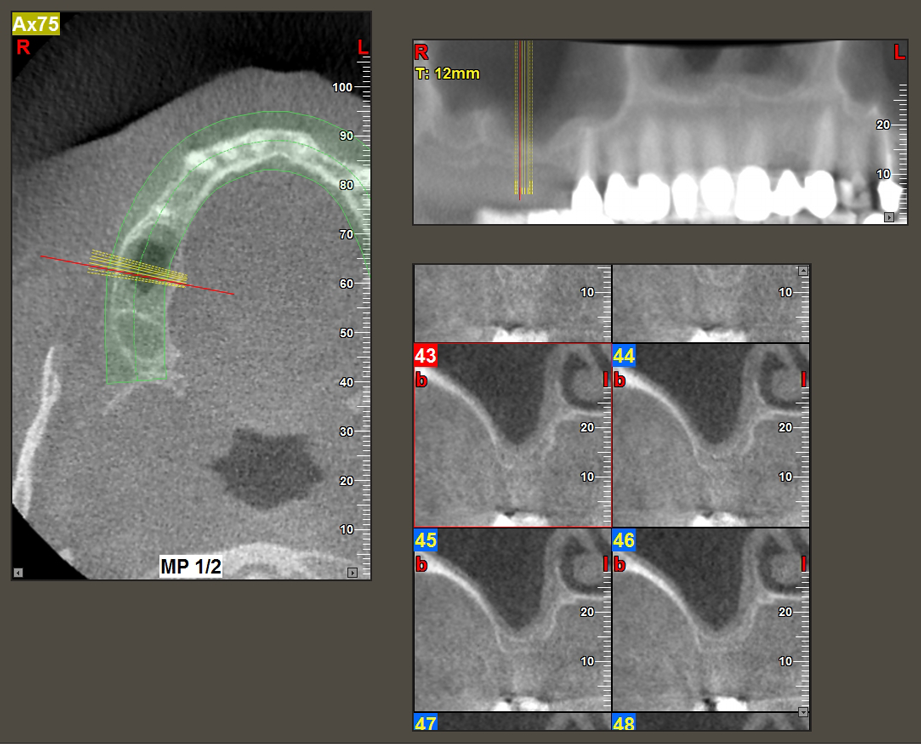 Internal sinus lift – patient-friendly with piezo surgery | W&H
