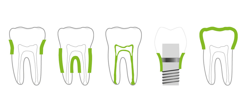 Piezo Scaler Tips | W&H