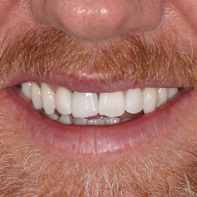 Prosthodontic Treatments | Dental Prostheses // 3Dental In Dublin ...