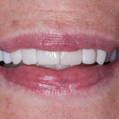 Prosthodontic Treatments | Dental Prostheses // 3Dental In Dublin ...