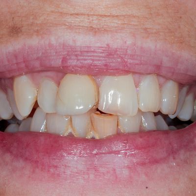 Prosthodontic Treatments | Dental Prostheses // 3Dental In Dublin ...