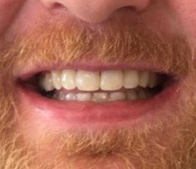 Orthodontics Treatment in Dublin, Limerick & Galway | Method & Cost ...