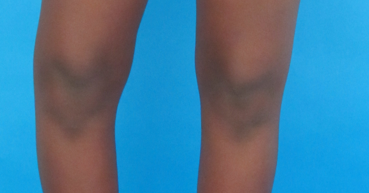 Morbus Blount | ZEM-Germany