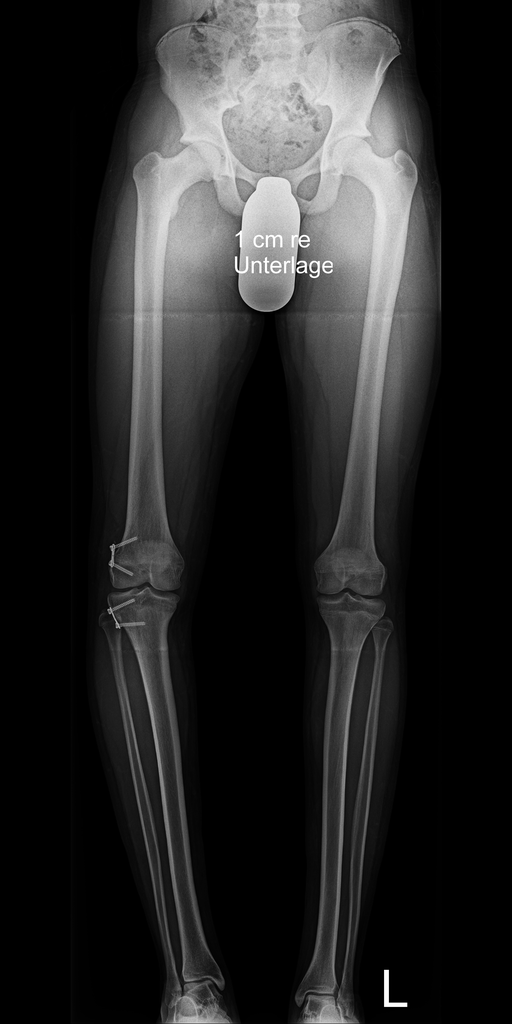 Morbus Blount | ZEM-Germany