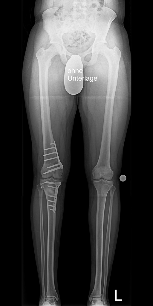 Morbus Blount | ZEM-Germany