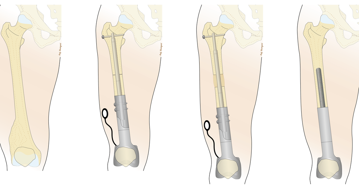 Growth prosthesis | ZEM-Germany