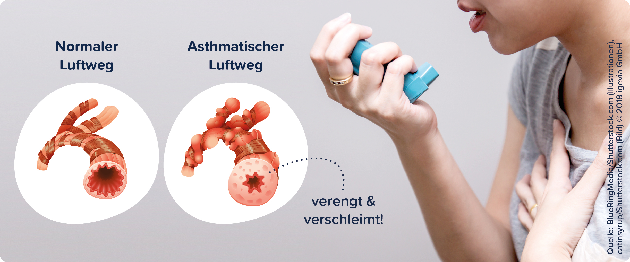 Welt-Asthma-Tag: Viele Allergiker mit Atemnot - igevia