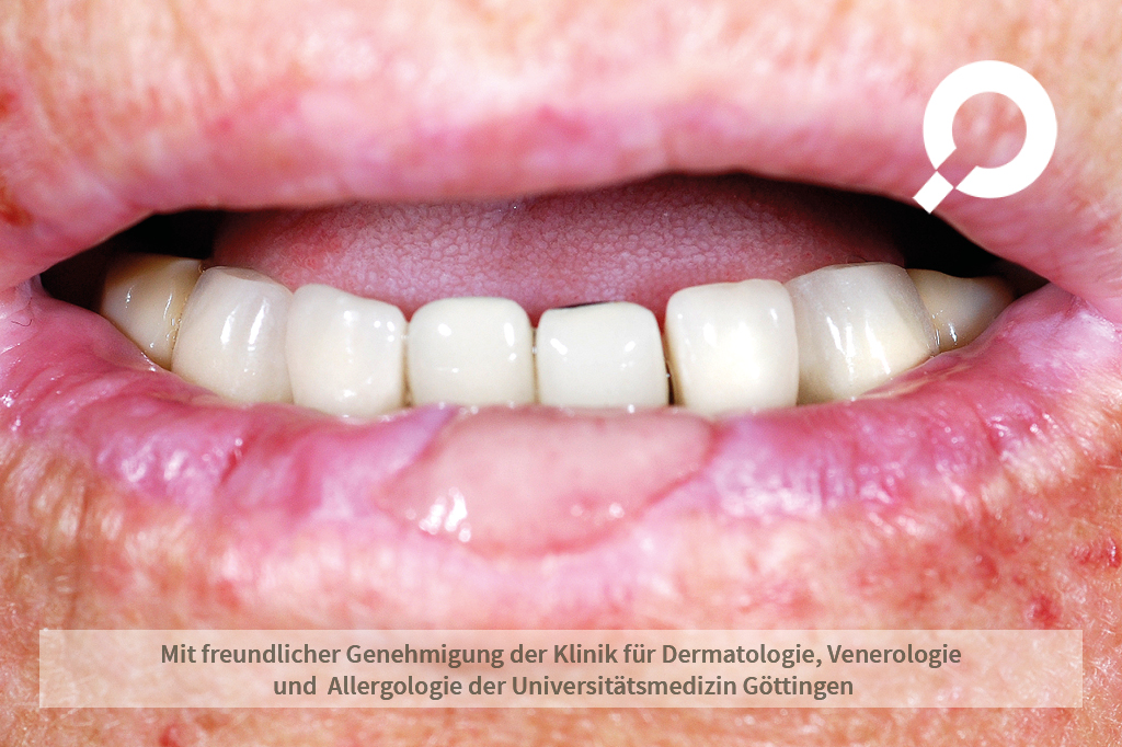 Aphten - dermanostic