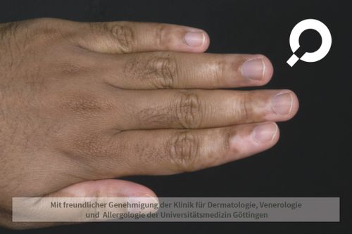 Verwunderlich Plotzlich Weie Finger Bilder