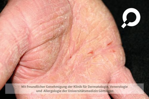 Handekzem: was tun bei strapazierter haut?: handekzem symptome und ...