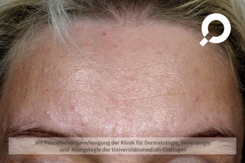 Akne (Acne vulgaris) - dermanostic