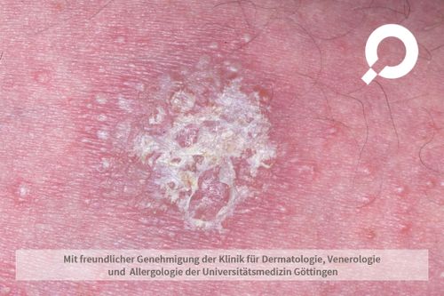 Psoriasis vulgaris (Schuppenflechte) - dermanostic