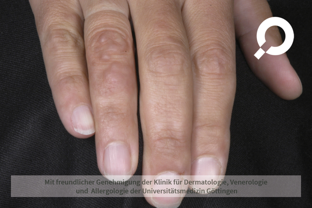 Granuloma anulare - dermanostic