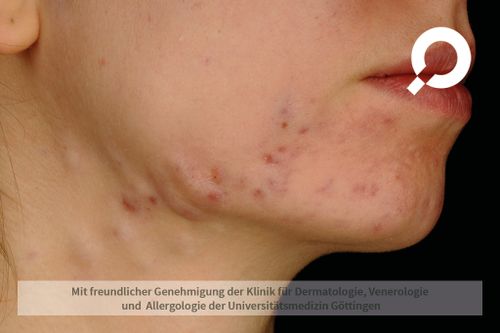Abszess (Eiterbeule) - dermanostic