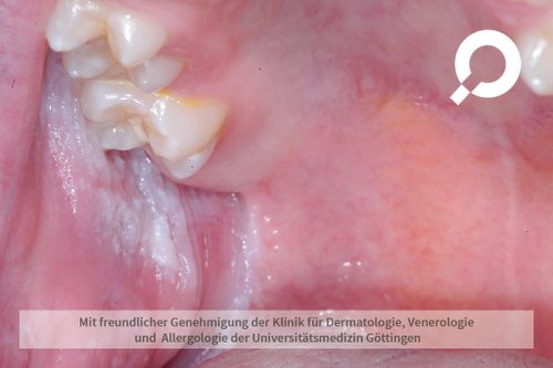 Erythroplakie Des Weichen Gaumens