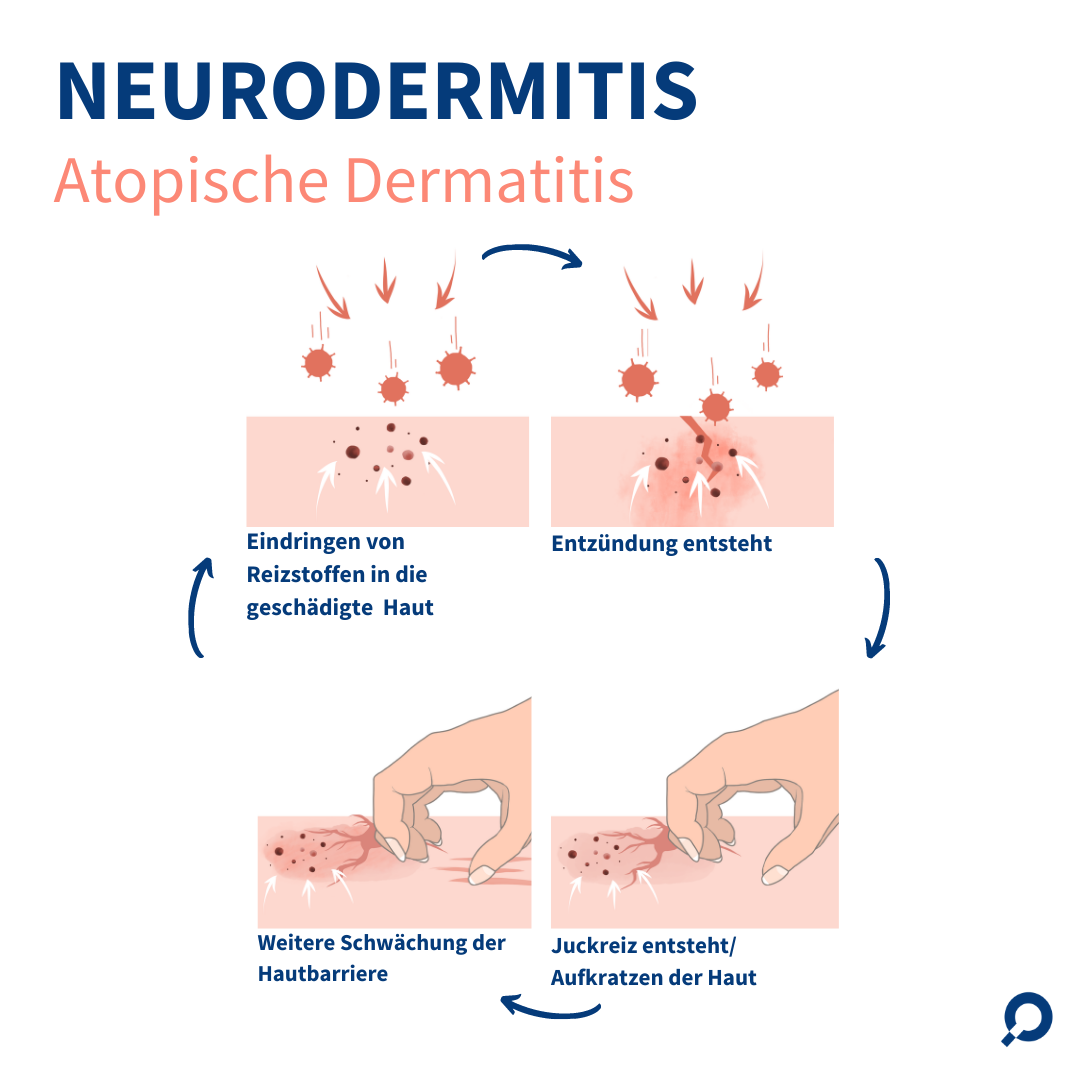 Atopische Dermatitis (Neurodermitis) - dermanostic