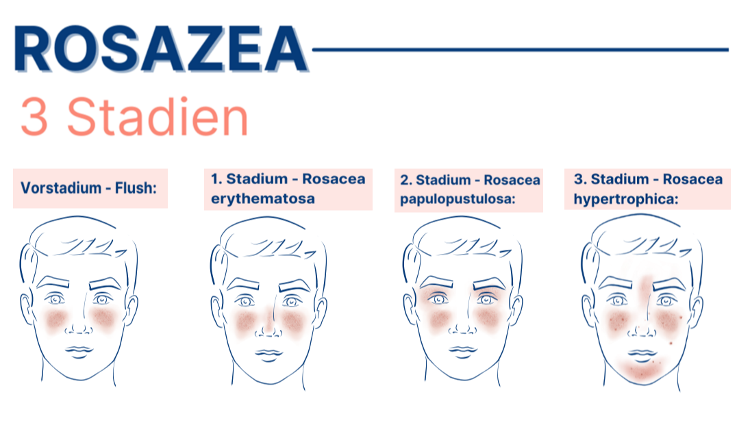 Rosacea (Rosazea) - dermanostic
