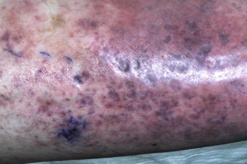 Stauungsdermatitis – Stauungsdermatitis – WPFCP