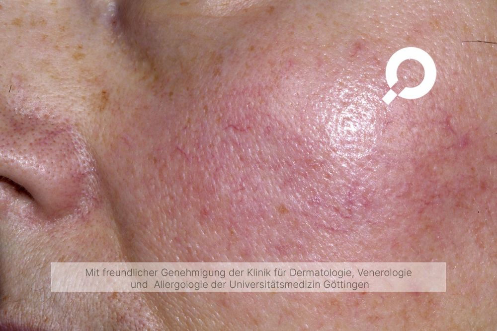 Rosacea (Rosazea) - dermanostic