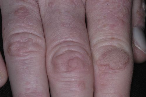 Verruca vulgaris (Dornwarzen) - dermanostic