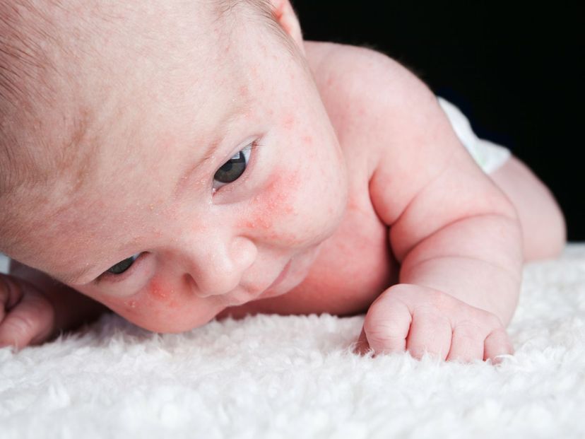 Unraveling the Mystery of Infant Milia: Causes, Care, and…