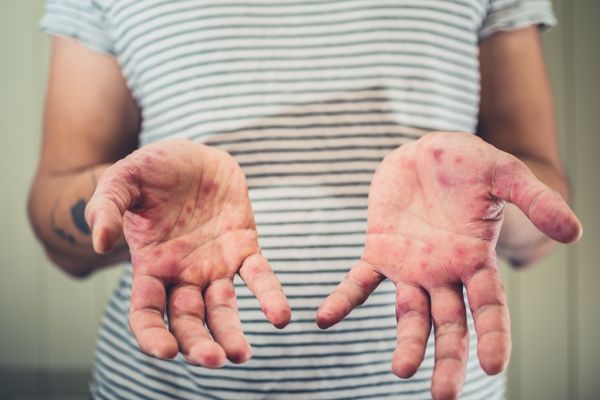 What the Connect Pedia Doctor shares about Hand, foot, and mouth ...