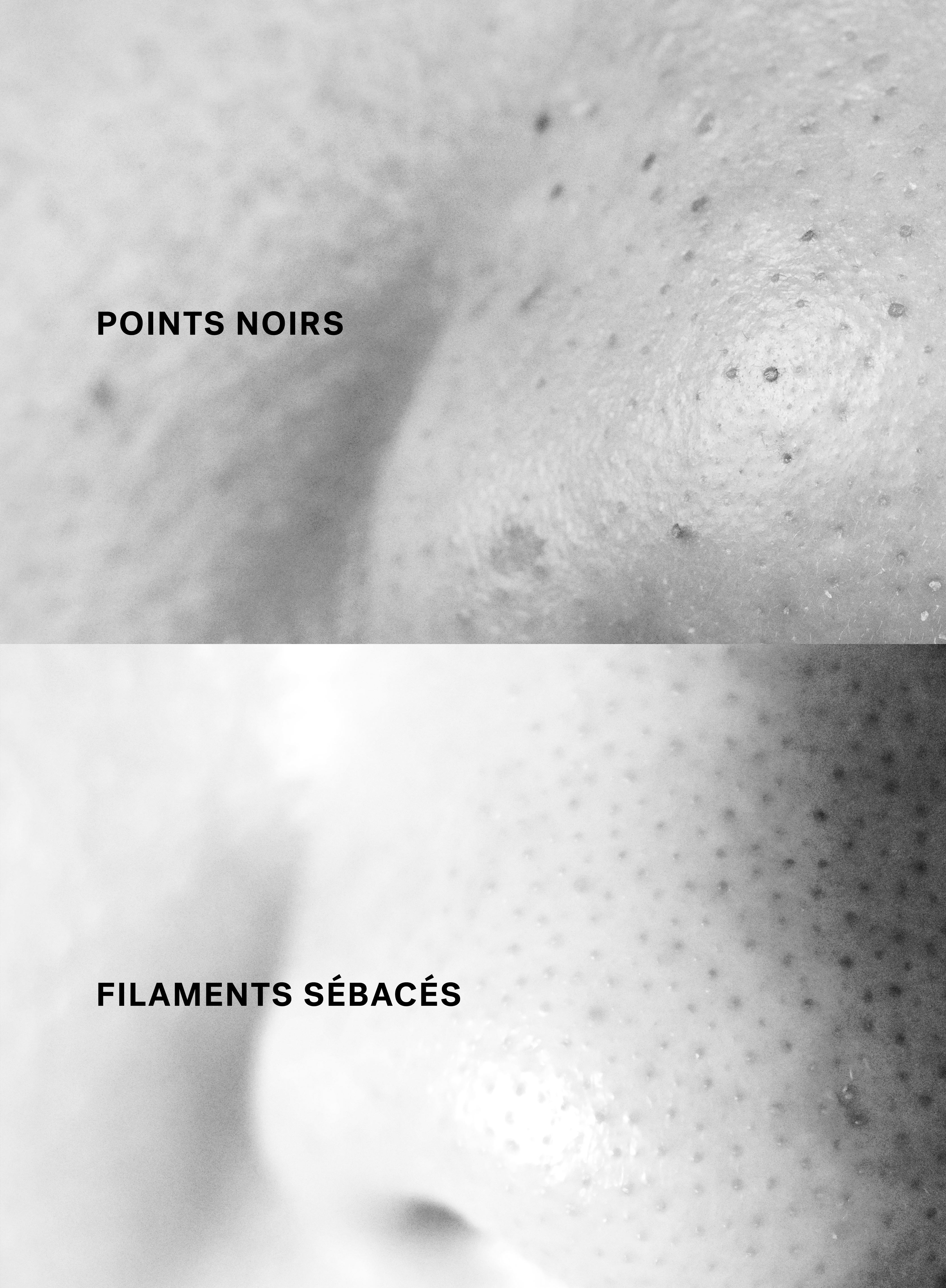 Comment éliminer les points noirs sur le nez ? — Typology